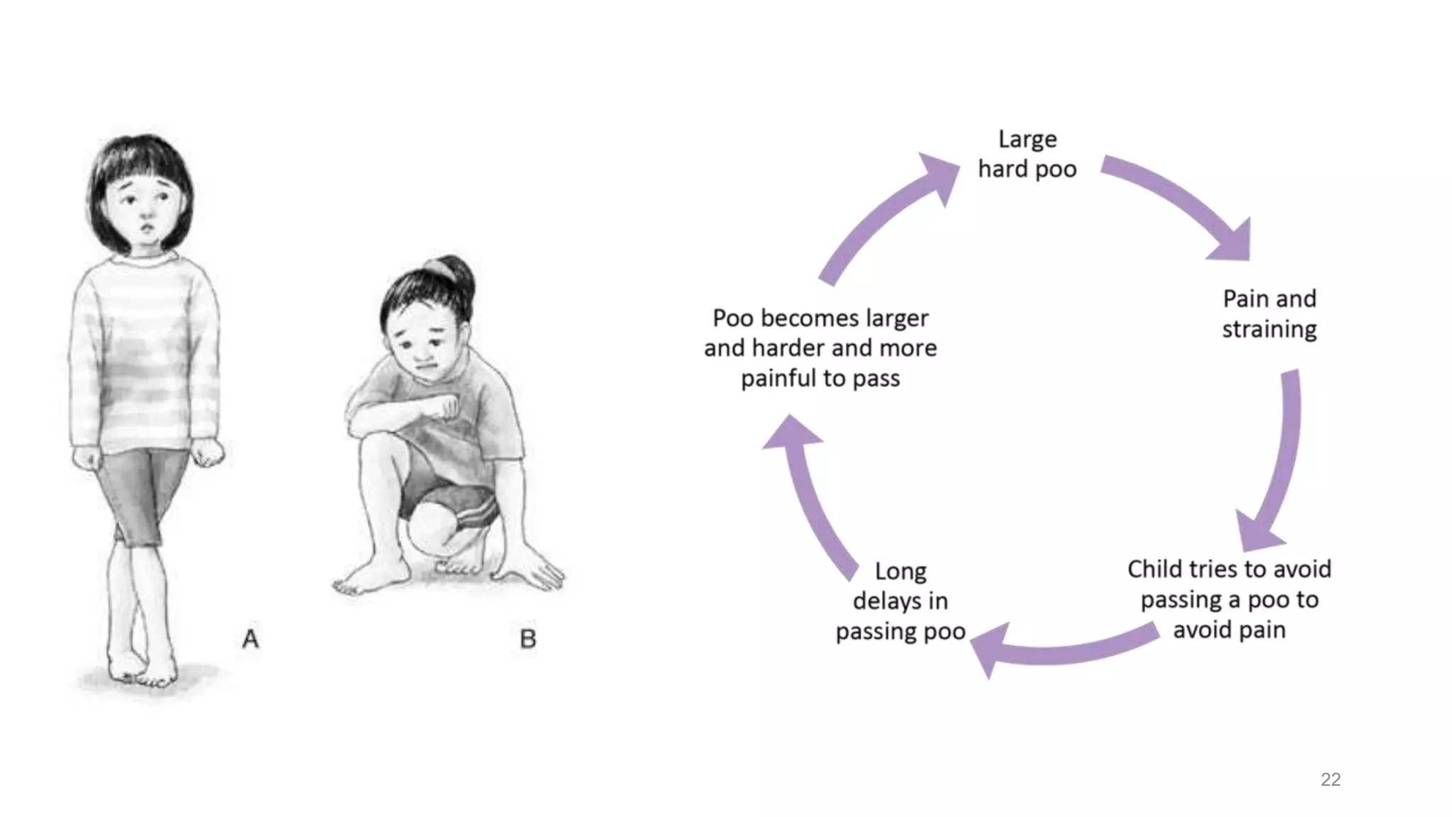 Overview of Childhood Constipation | PPT