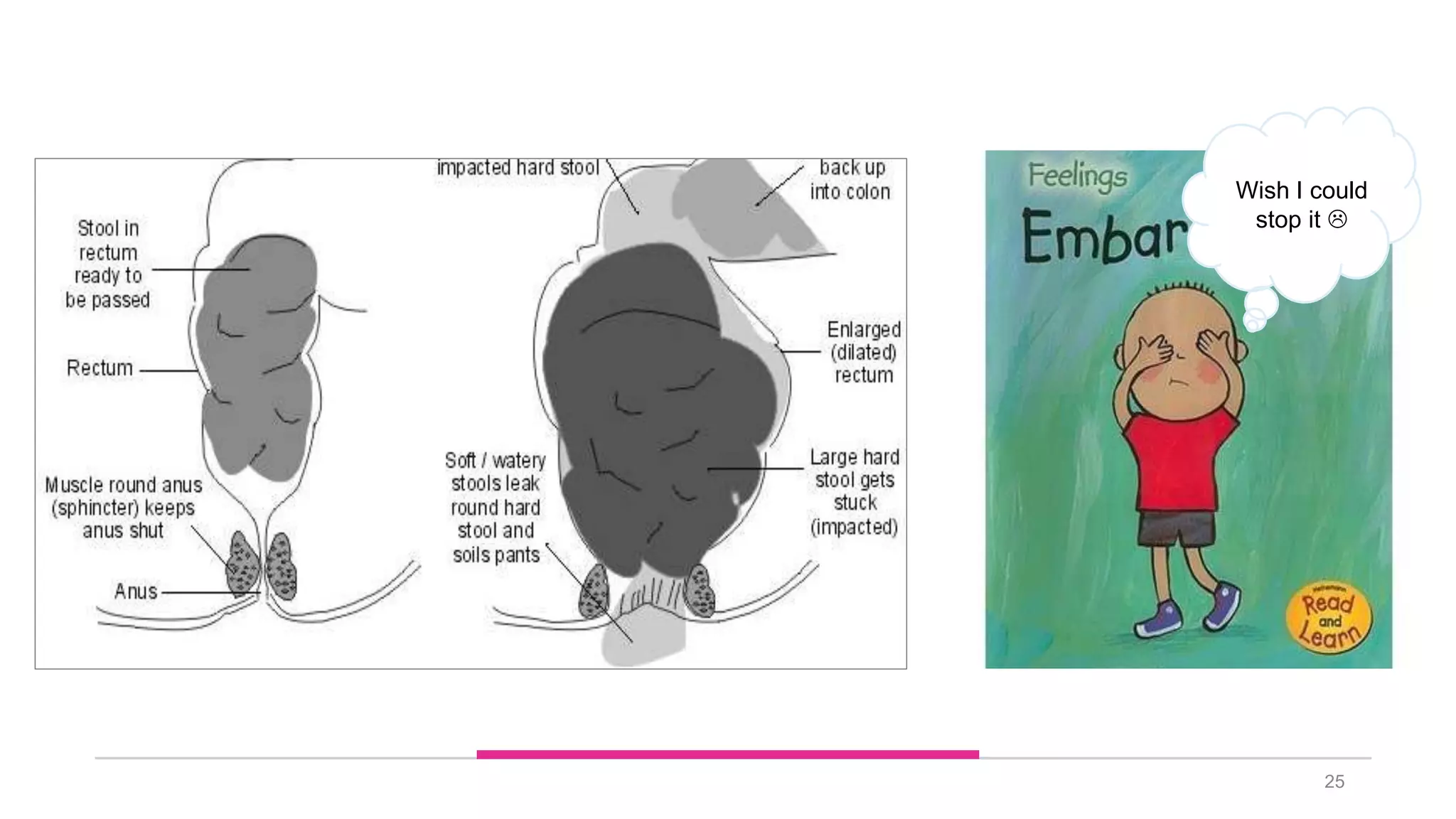 Overview of Childhood Constipation | PPT