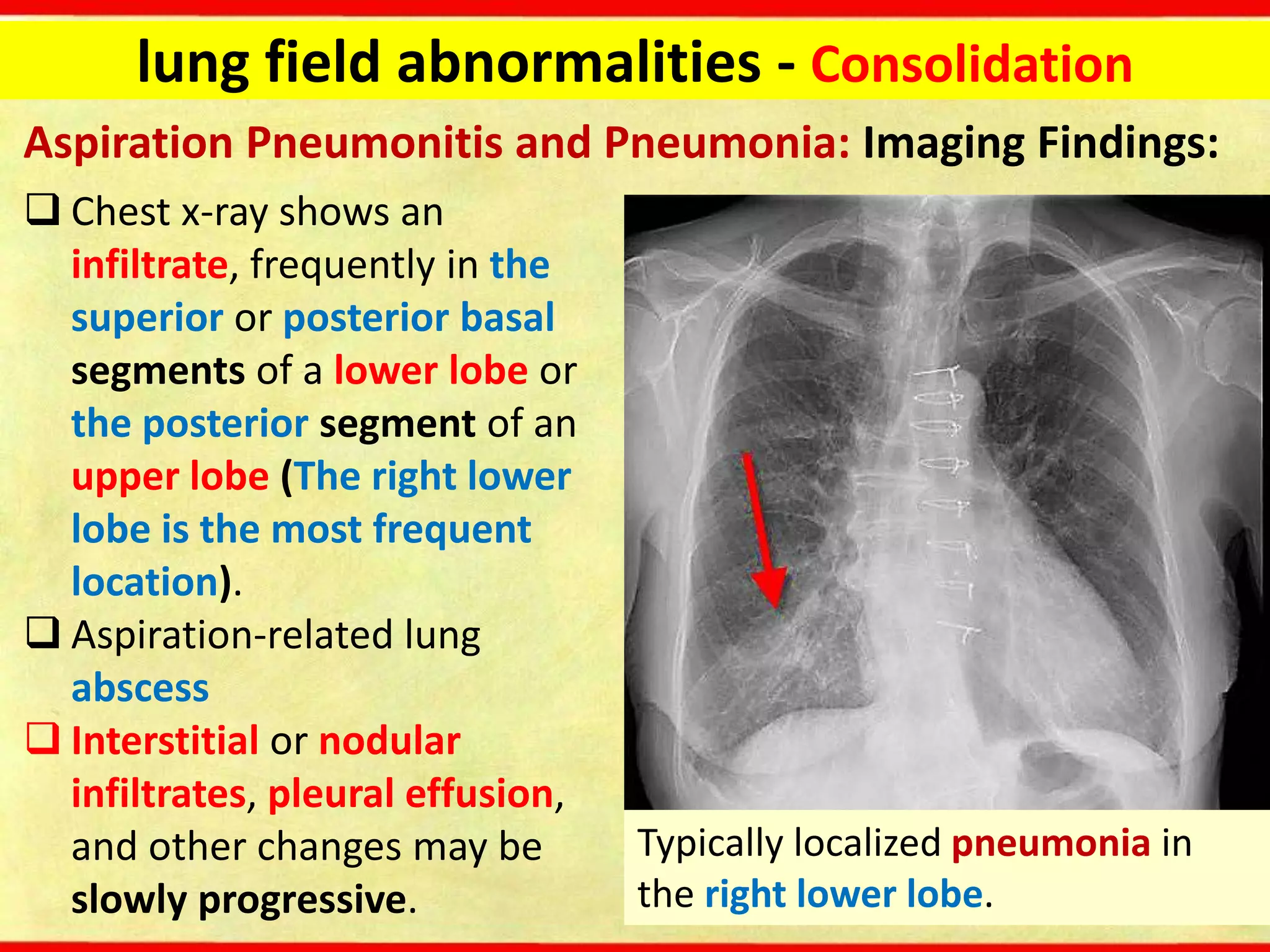 Overview of community-acquired pneumonia in adults.pdf