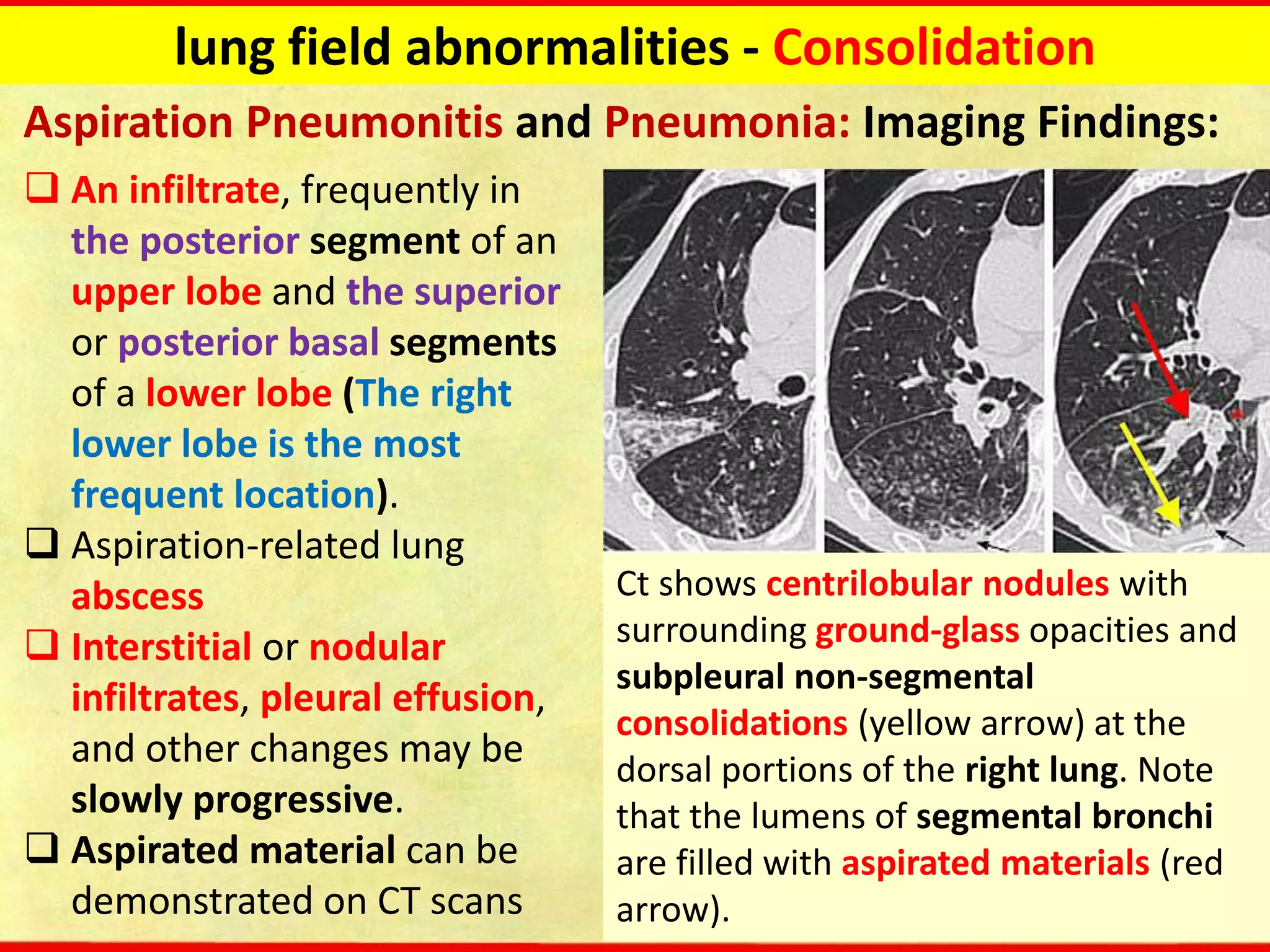 Overview of community-acquired pneumonia in adults.pdf