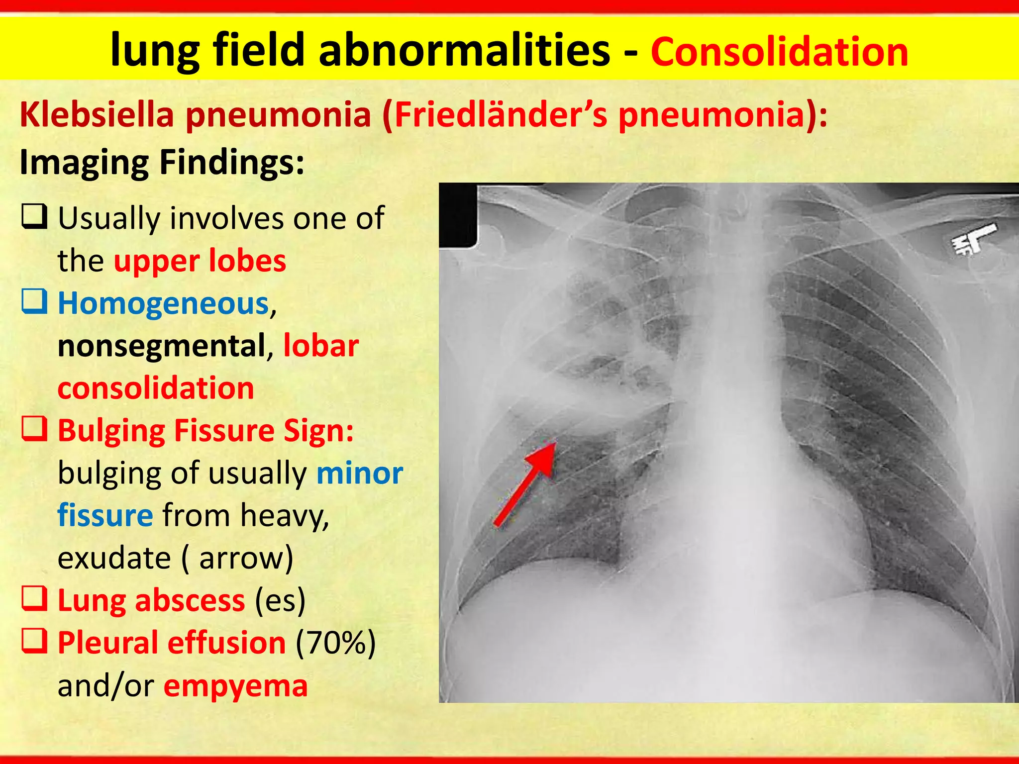 Overview of community-acquired pneumonia in adults.pdf