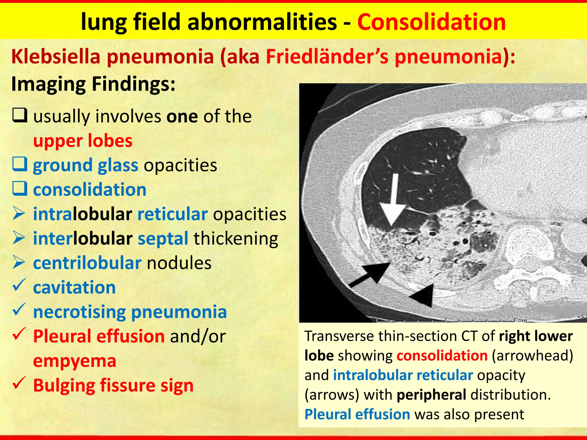 Overview of community-acquired pneumonia in adults.pdf