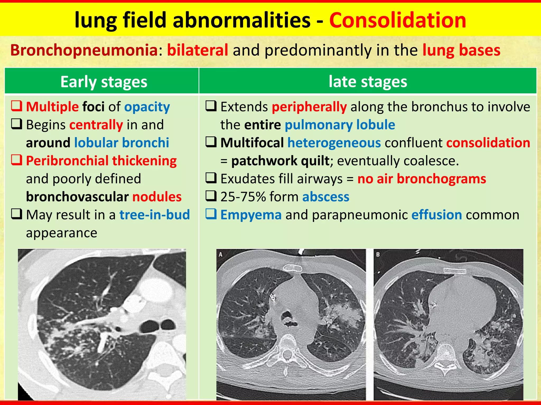 Overview of community-acquired pneumonia in adults.pdf