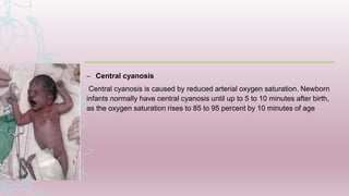Overview of cyanosis in the newborn | PPTX