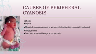 Overview of cyanosis in the newborn | PPTX