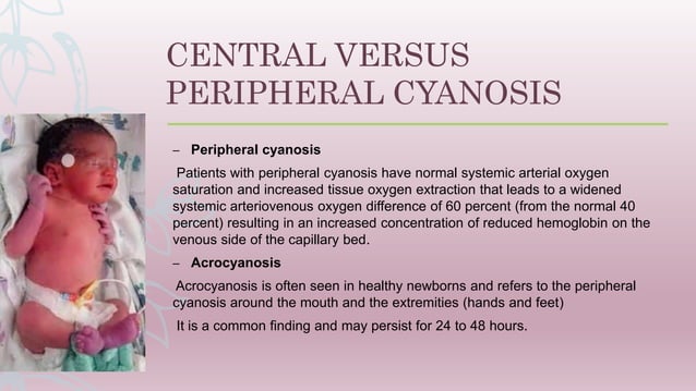 Overview of cyanosis in the newborn