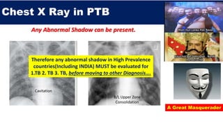 Overview of Diagnosis and Management of Drug Sensitive.pptx | Lung and ...