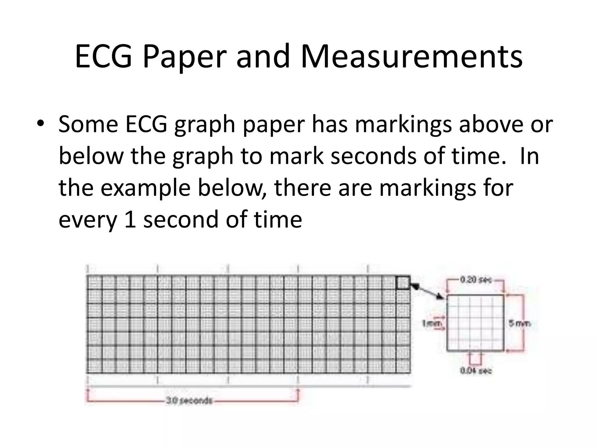 Overview of ecg part 1 | PPTX | Heart and Cardiovascular Diseases ...