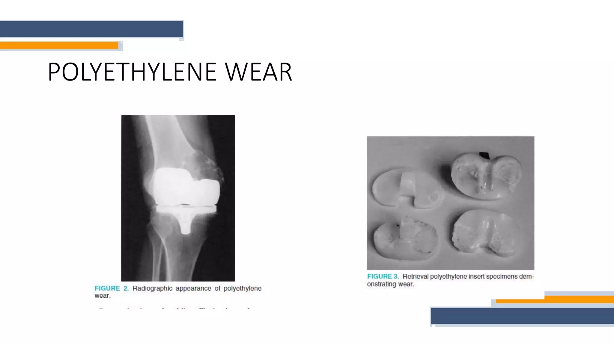 Overview of Failure Mechanisms and Indication for Revision Knee ...