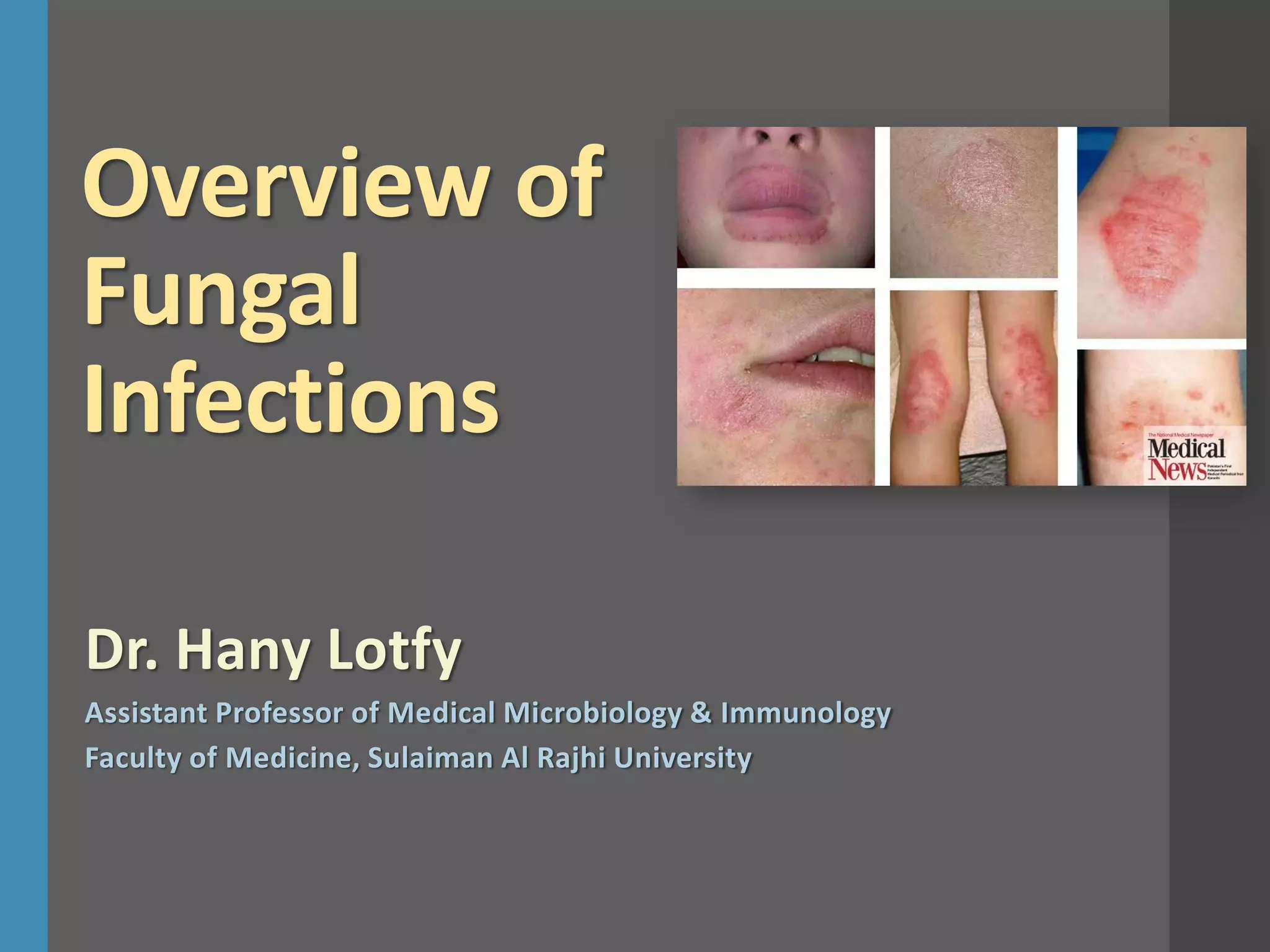 Overview of Fungal Infections | PDF