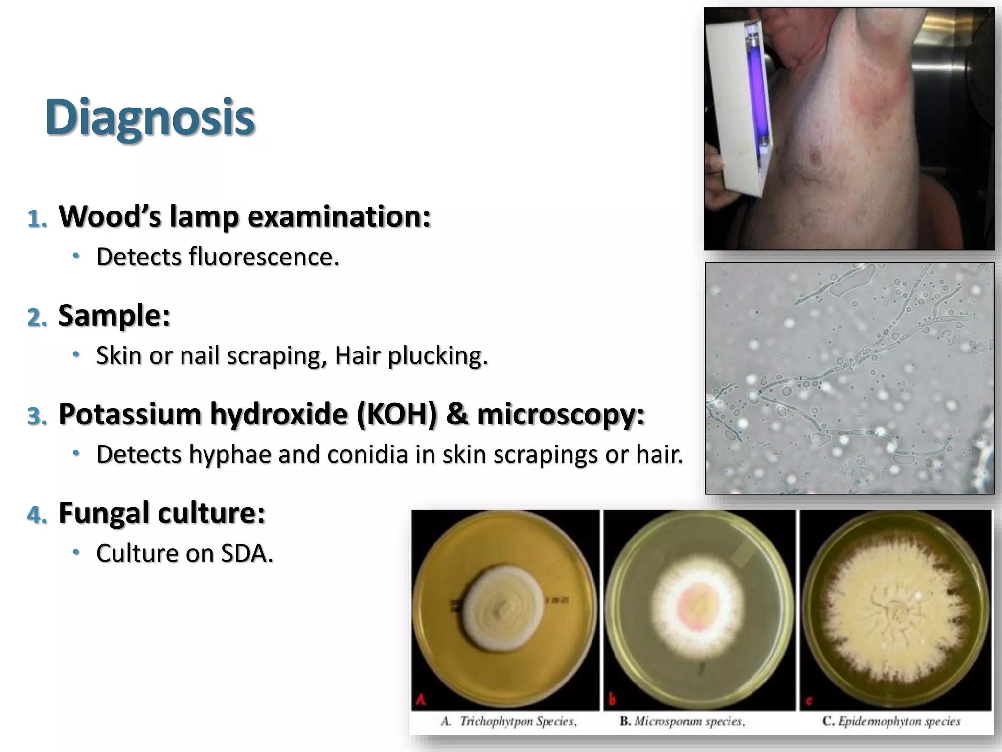 Overview of Fungal Infections | PDF