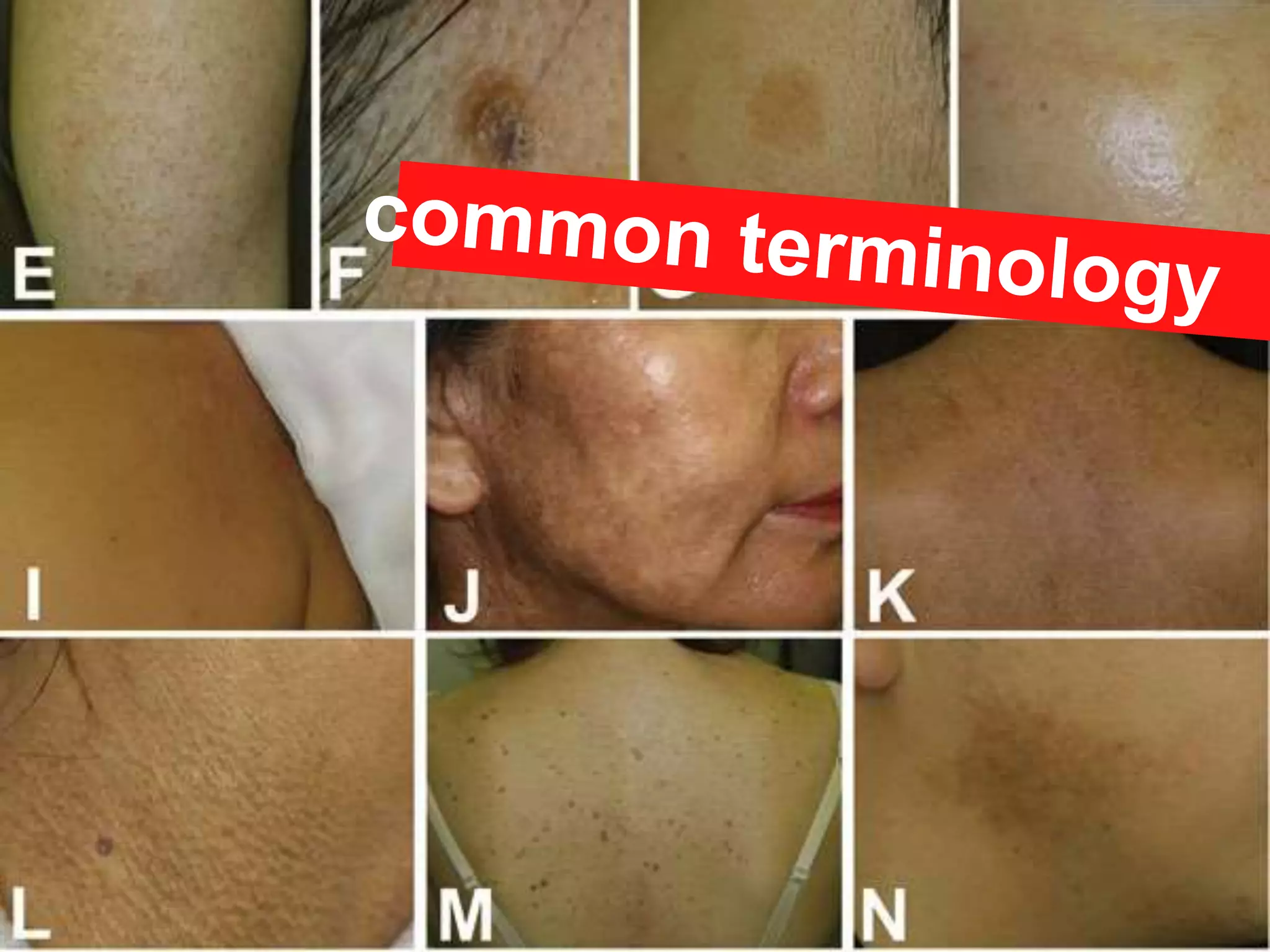 Overview of hyperpigmentation disorders | PPTX