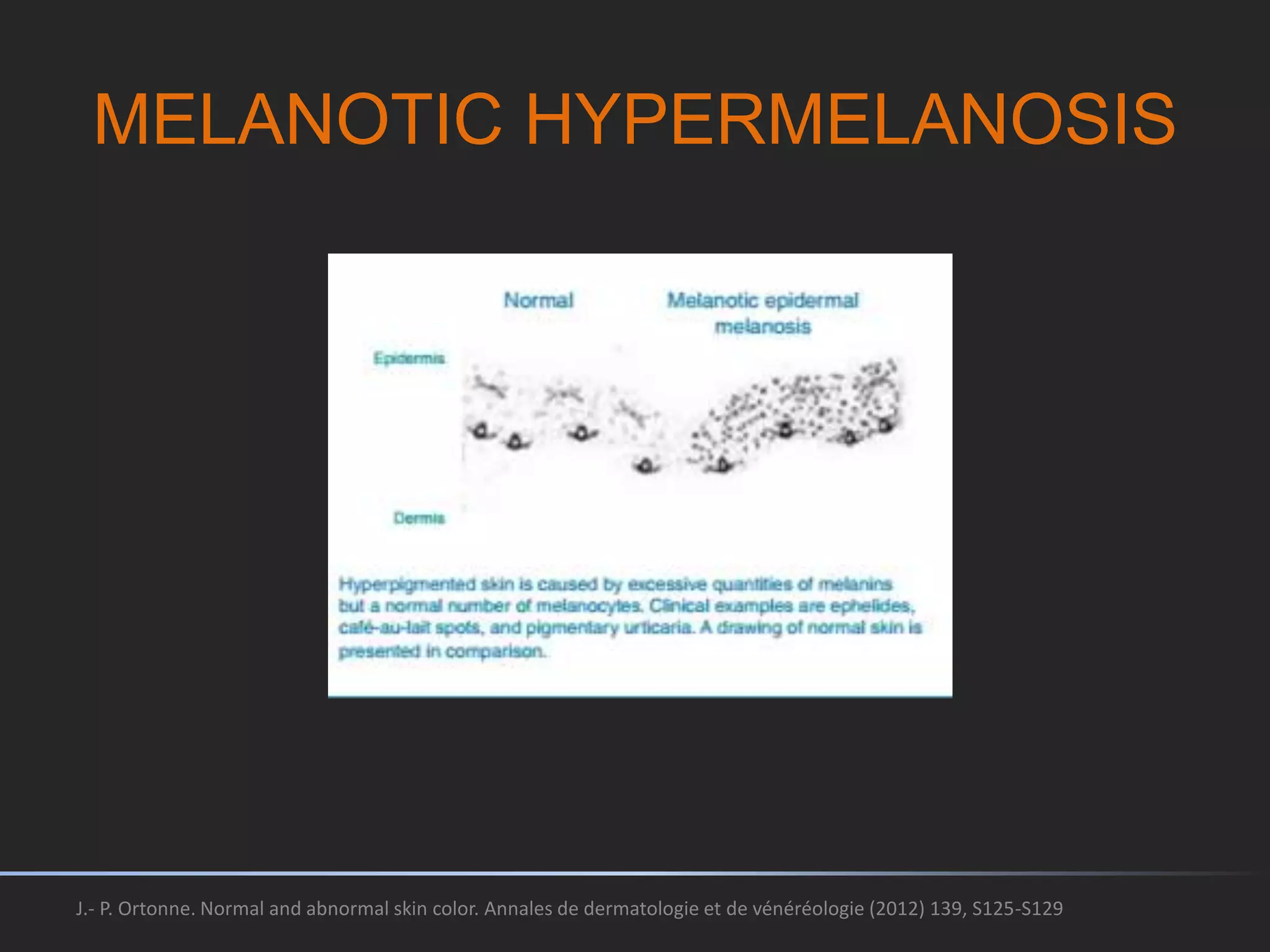 Overview of hyperpigmentation disorders | PPTX