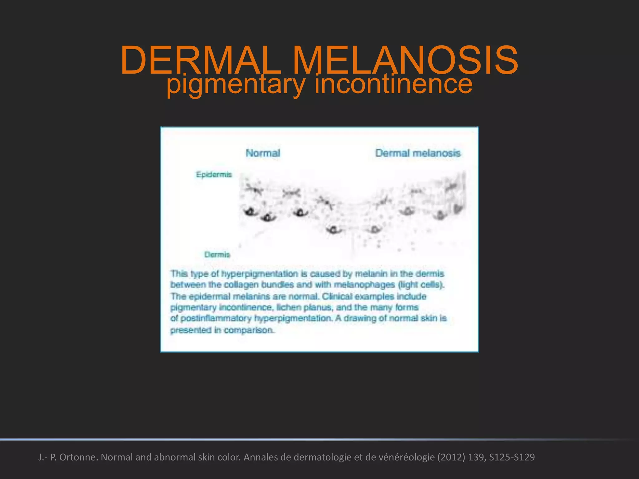 Overview of hyperpigmentation disorders | PPTX