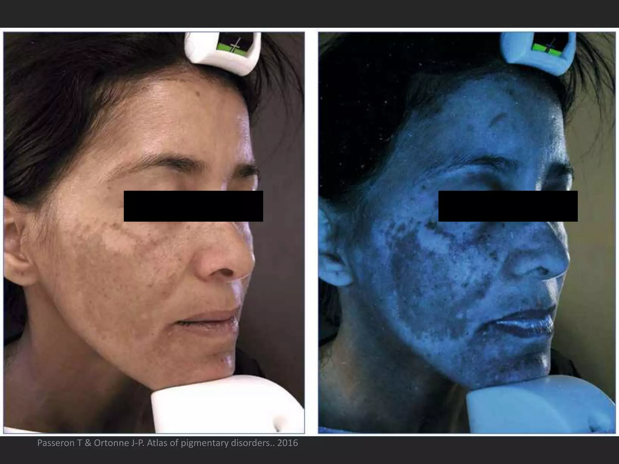 Overview of hyperpigmentation disorders | PPTX