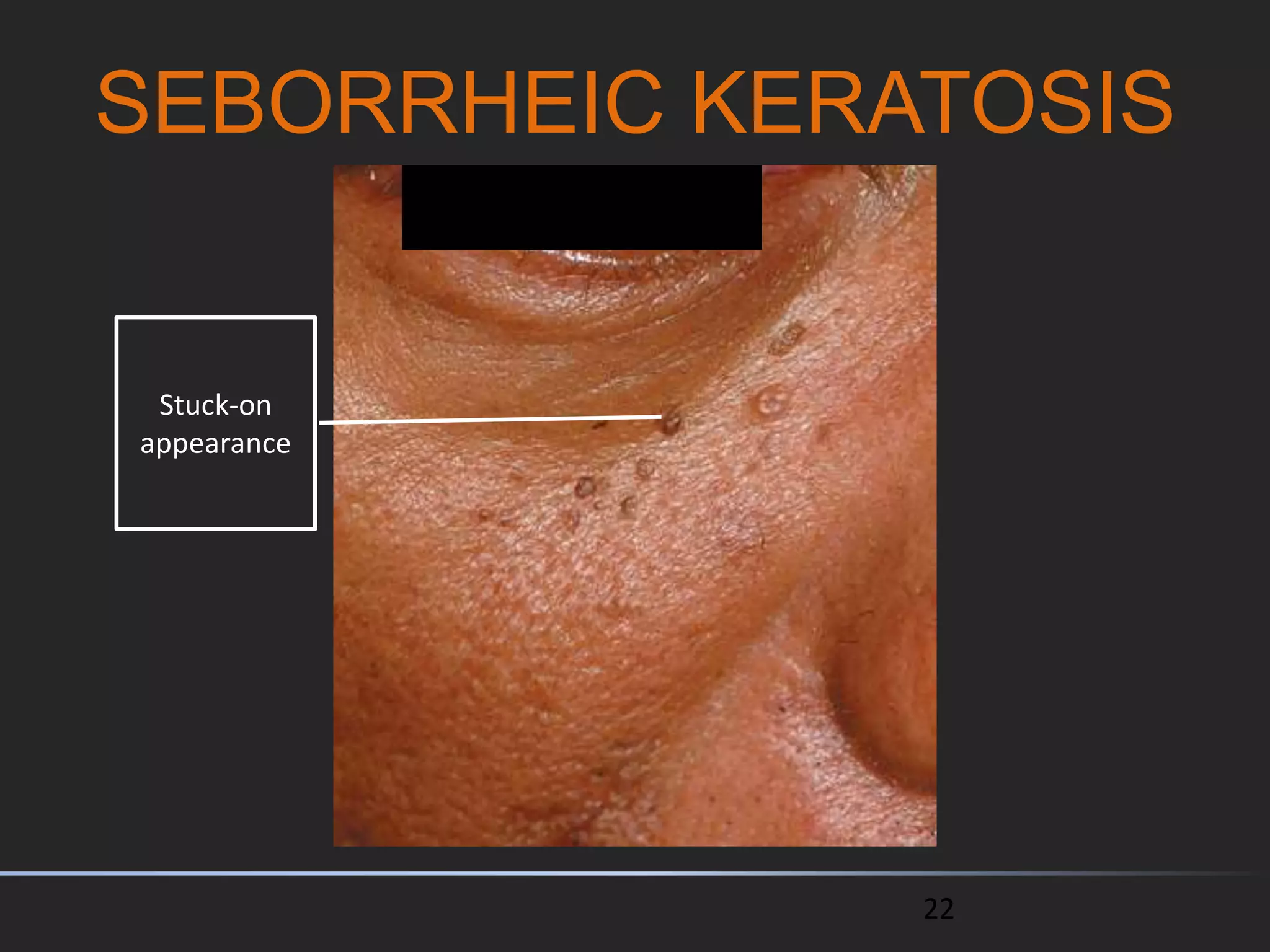 Overview of hyperpigmentation disorders | PPTX