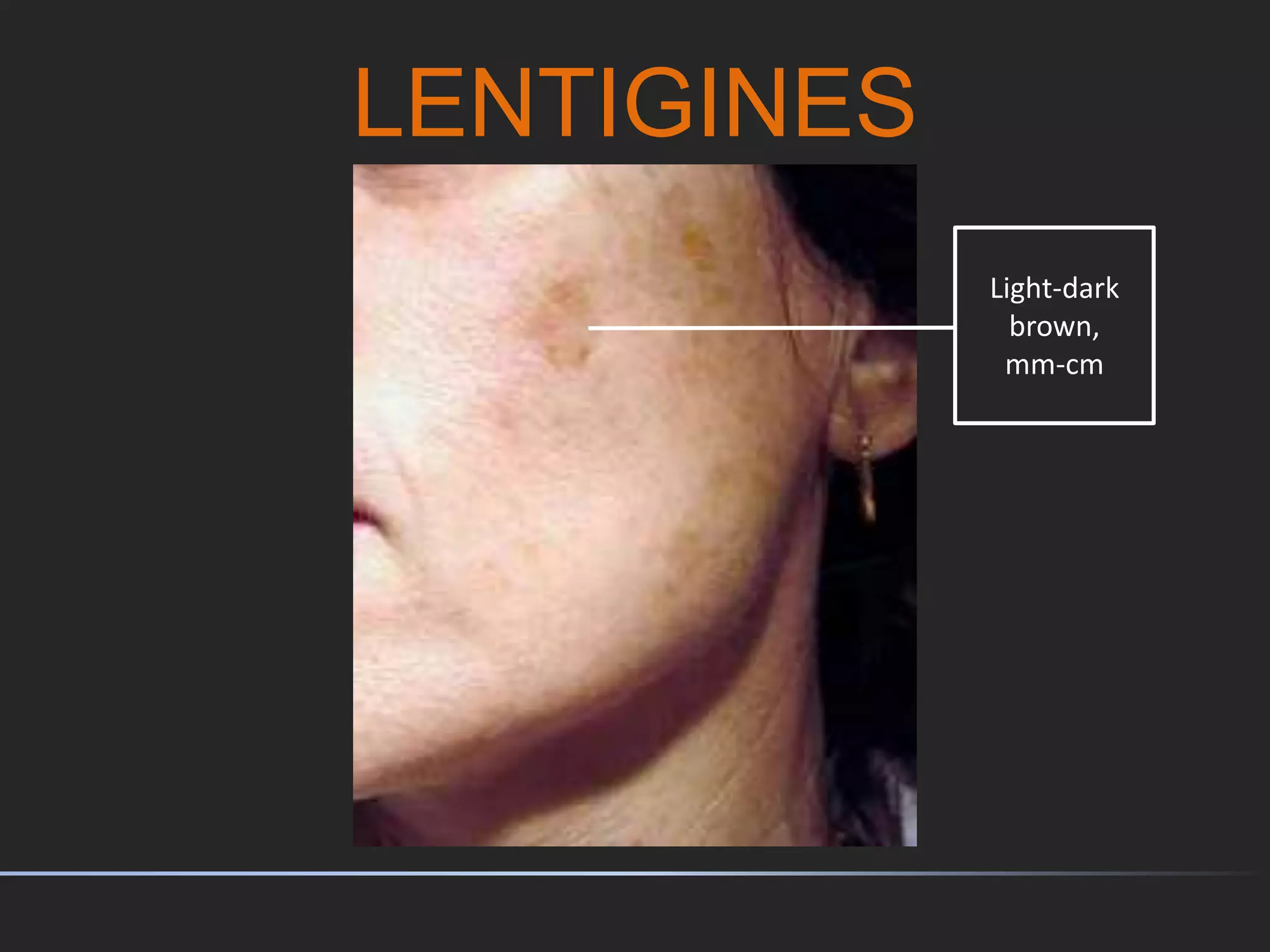 Overview of hyperpigmentation disorders | PPTX