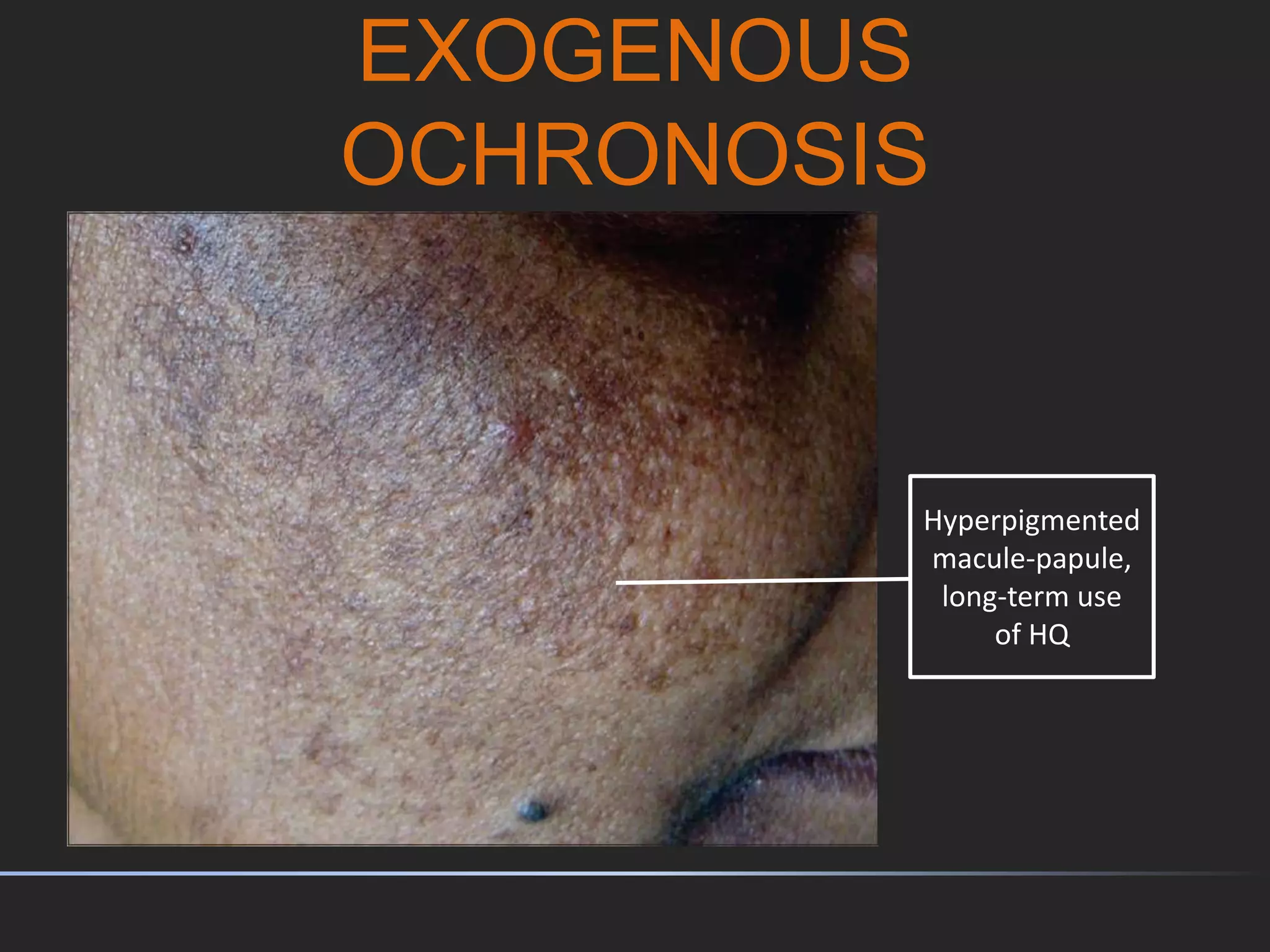 Overview of hyperpigmentation disorders | PPTX