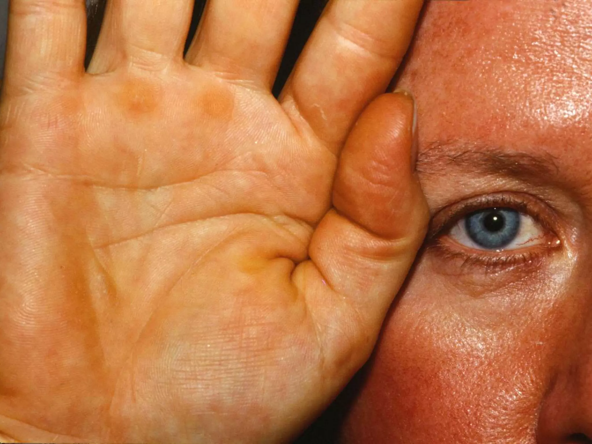 Overview of hyperpigmentation disorders | PPTX