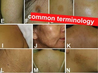 Overview of hyperpigmentation disorders | PPTX