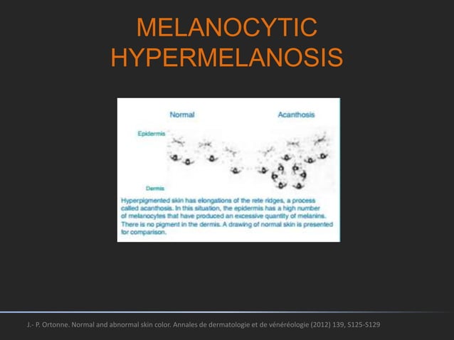 Overview of hyperpigmentation disorders | PPTX | Skin and Dermatology ...