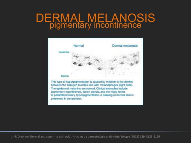 Overview of hyperpigmentation disorders | PPTX | Skin and Dermatology ...