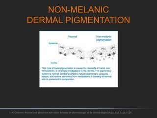 Overview of hyperpigmentation disorders | PPTX | Skin and Dermatology ...