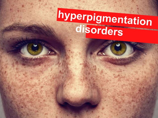 Overview of hyperpigmentation disorders | PPTX | Skin and Dermatology ...