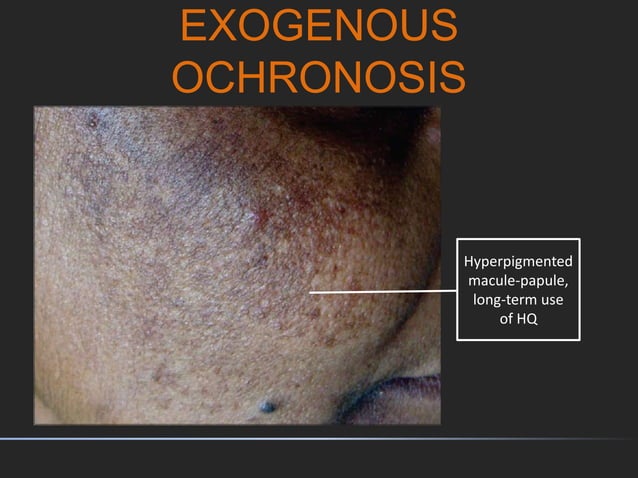 Overview of hyperpigmentation disorders | PPTX | Skin and Dermatology ...