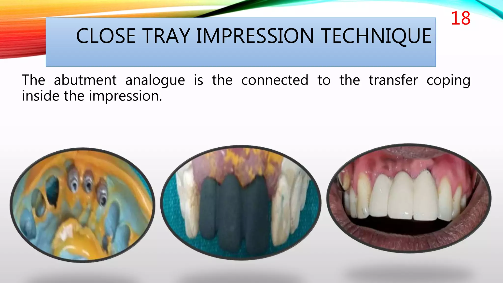 Overview of impression technique in implant dentistry.pptx