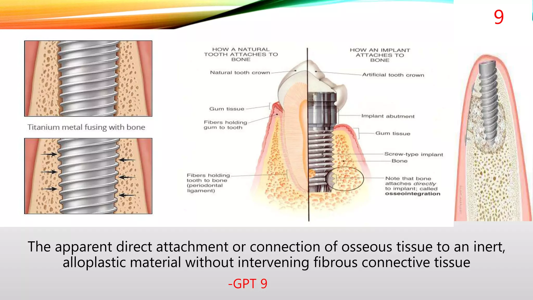 Overview of impression technique in implant dentistry.pptx