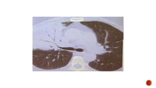 Overview of interstitial lung diseases | PPTX