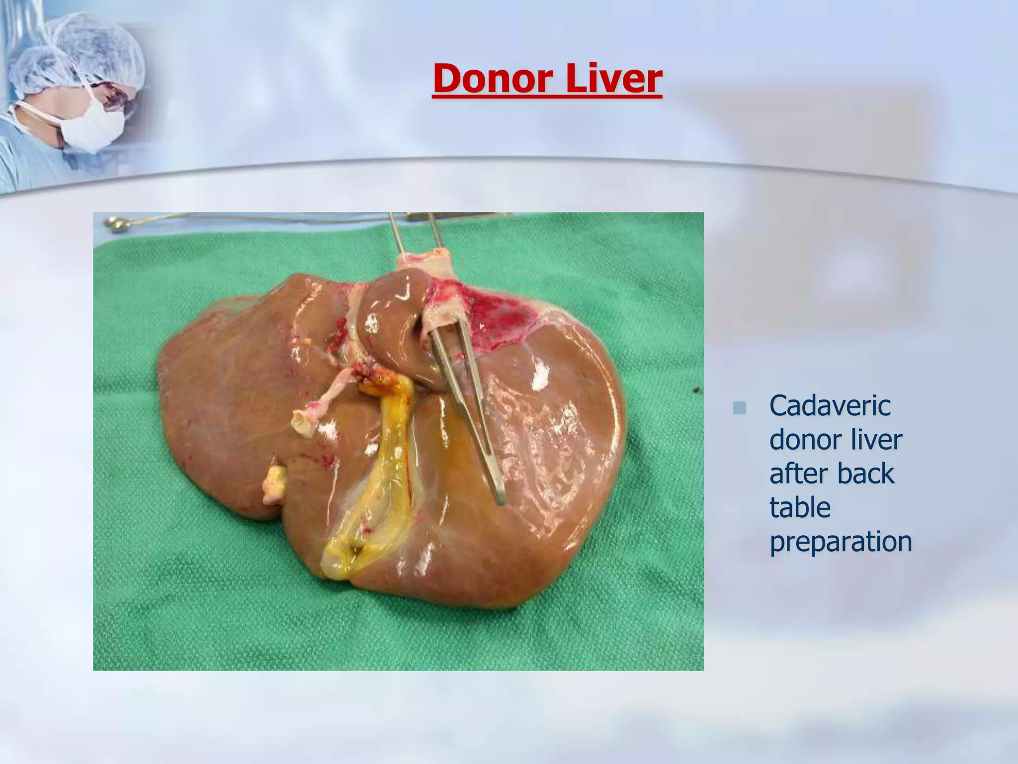 Overview of liver transplantation | PPT