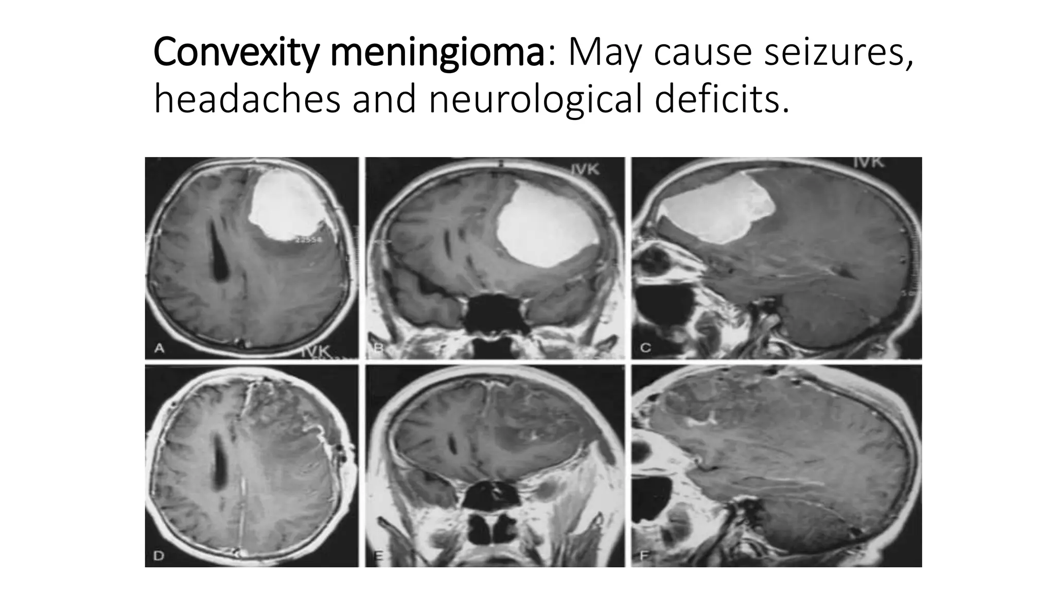 Overview of Meningioma (Short review of types,symptoms and treatment) | PPT