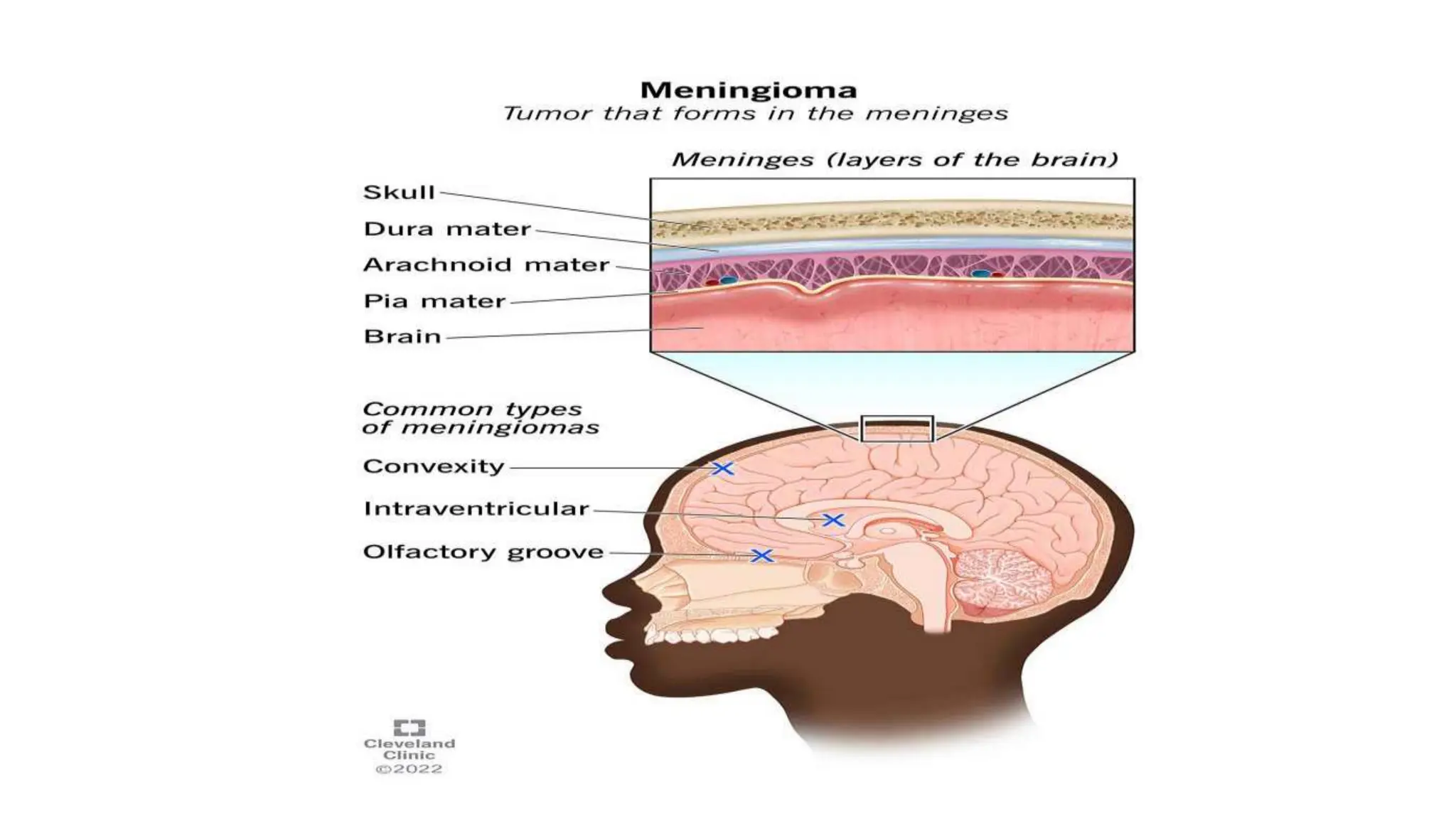 Overview of Meningioma (Short review of types,symptoms and treatment) | PPT