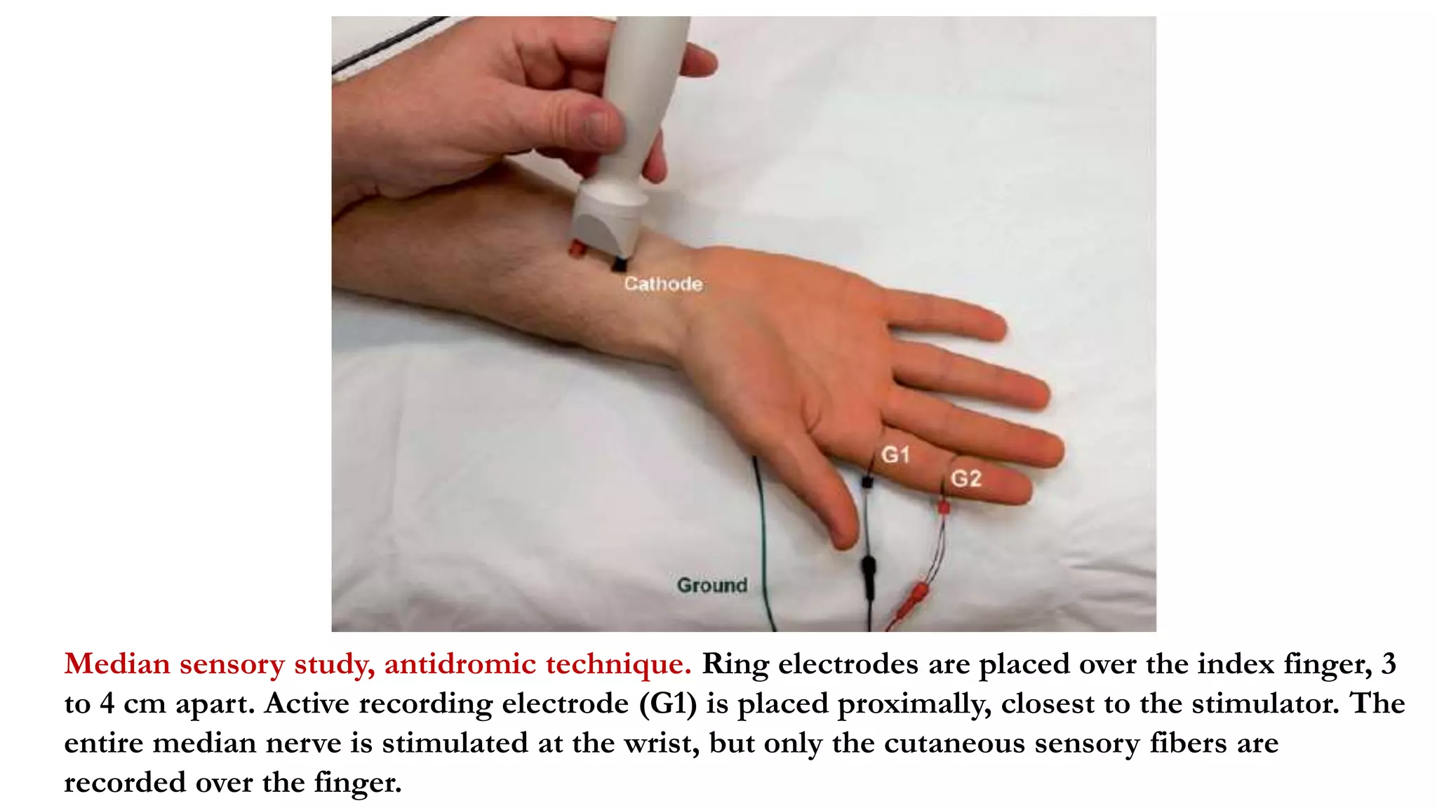 Overview of Nerve Conduction Study | PPTX | Brain and Nervous System ...