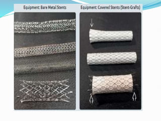 Overview of Stents in Interventional Radiology.pptx