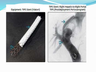 Overview of Stents in Interventional Radiology.pptx