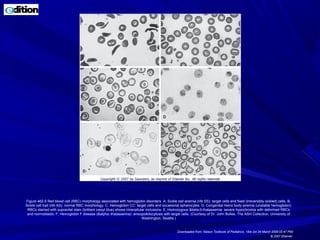Overview of thalassemia 2 | PPT