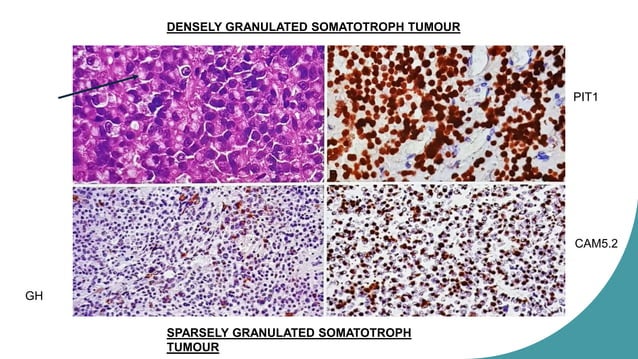 Overview of the 2022 WHO Classification of Pituitary.pptx | Endocrine ...