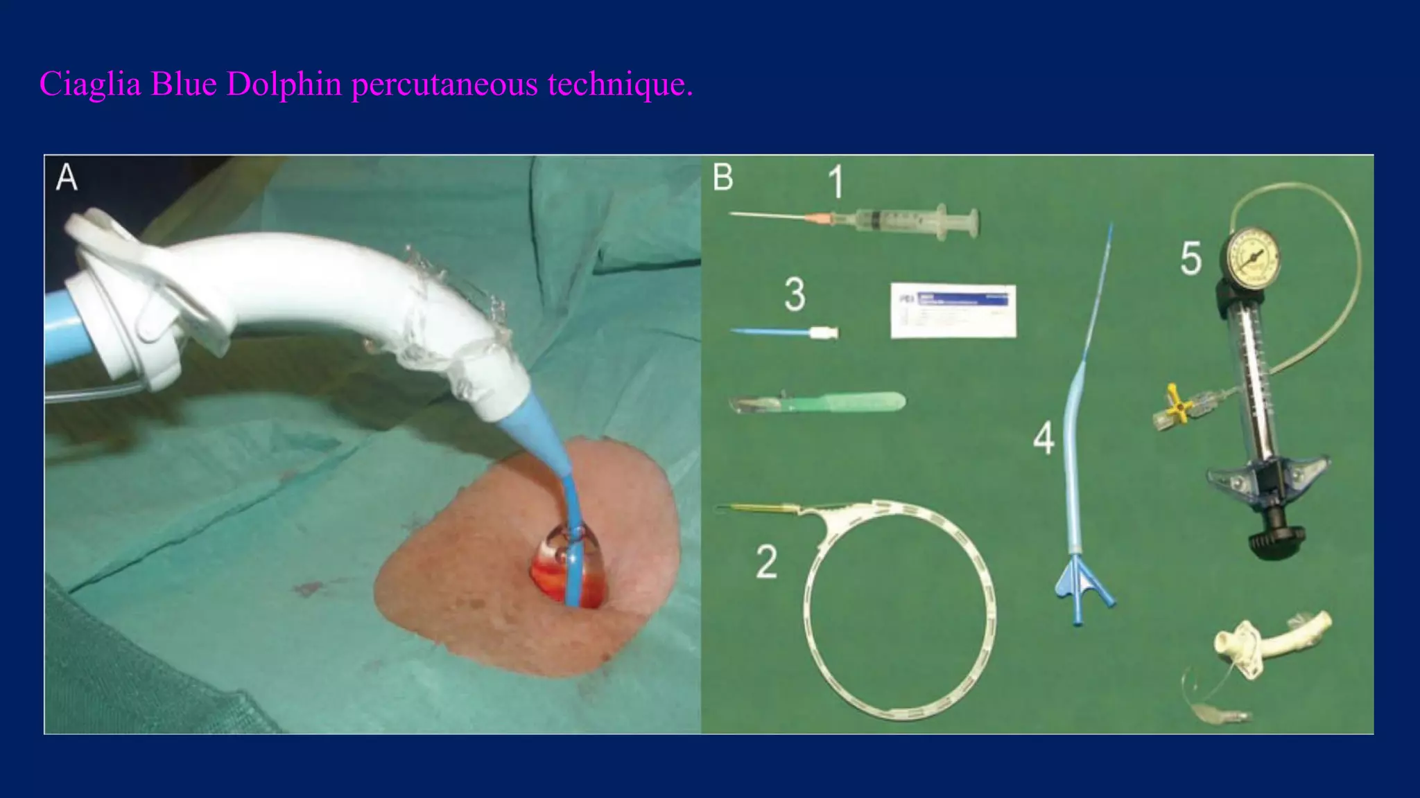 Overview of tracheostomy | PDF