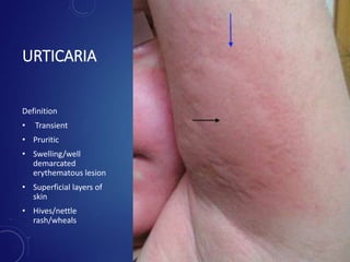 overview of urticaria.pptx | Free Download