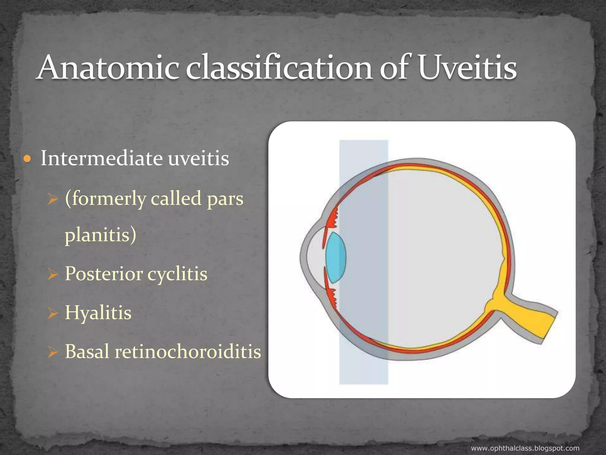 Overview Of Uveitis - Part1 Classification | PPTX