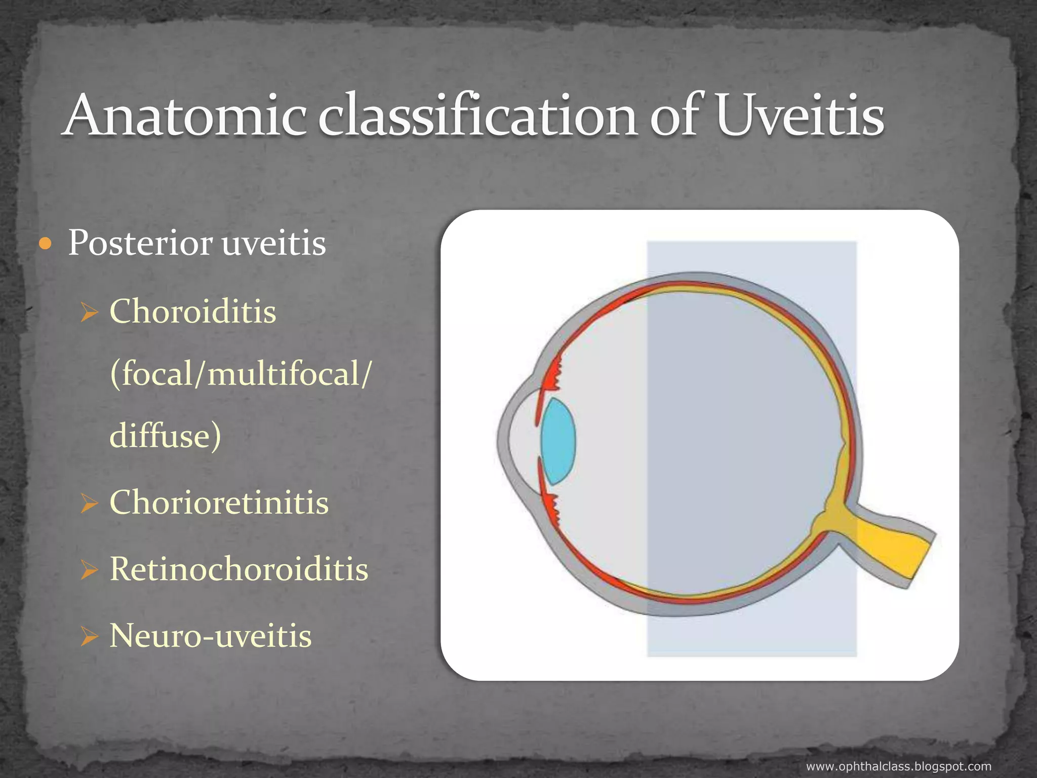 Overview Of Uveitis - Part1 Classification | PPTX