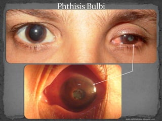 Overview Of Uveitis - Part1 Classification | PPTX