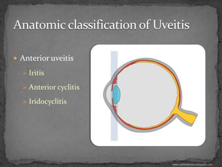 Overview Of Uveitis - Part1 Classification | PPTX