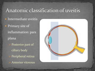 Overview Of Uveitis - Part1 Classification | PPTX