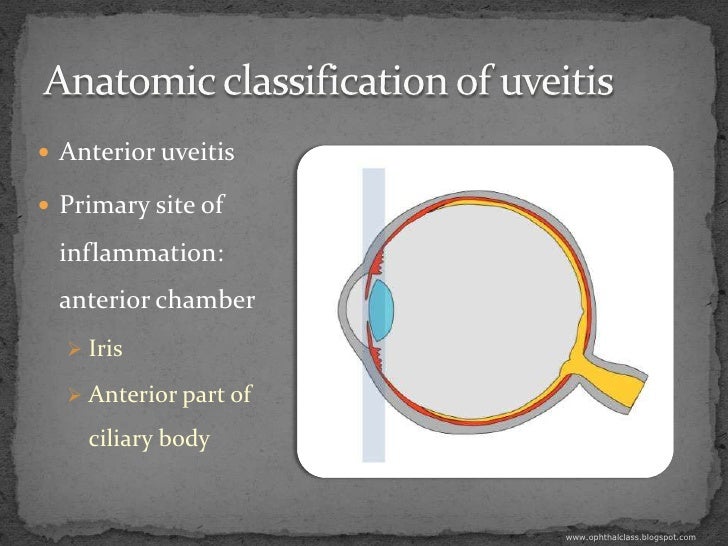 Overview Of Uveitis - Part1 Classification