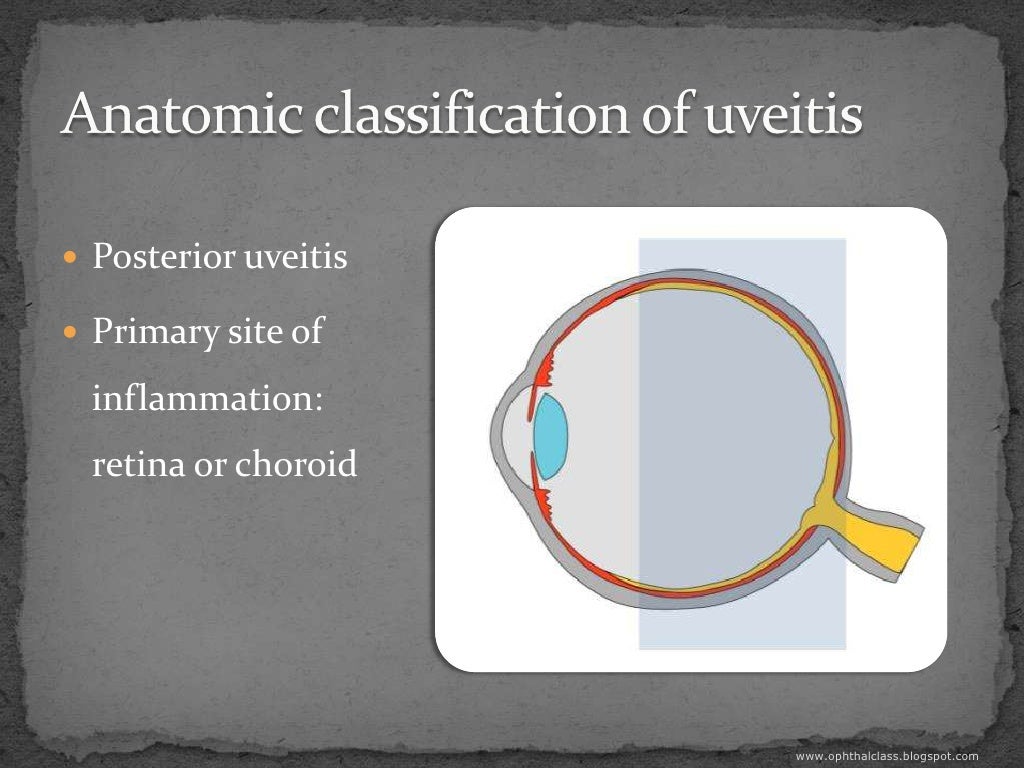 Overview Of Uveitis - Part1 Classification