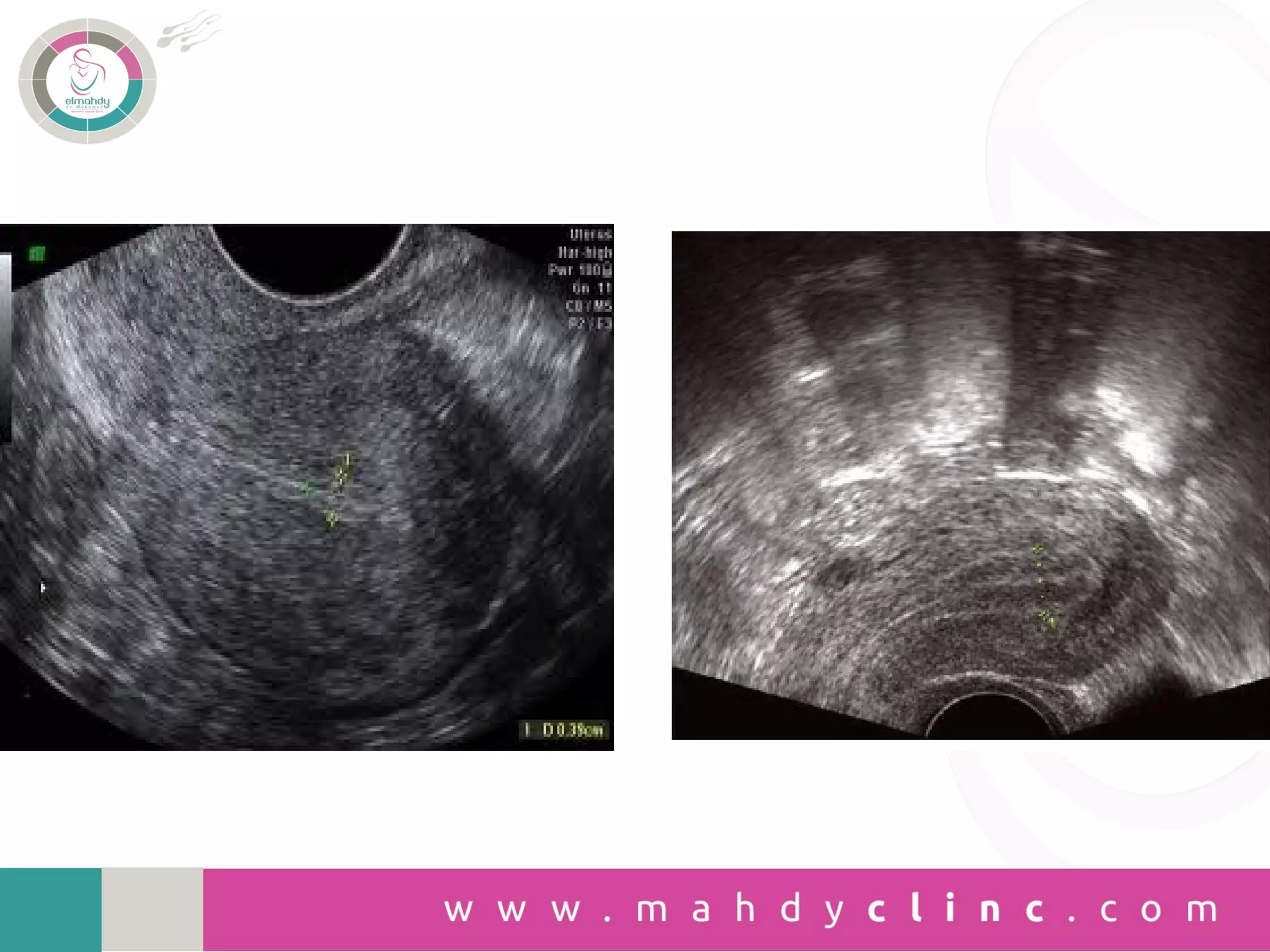 Ovulation induction | PPT